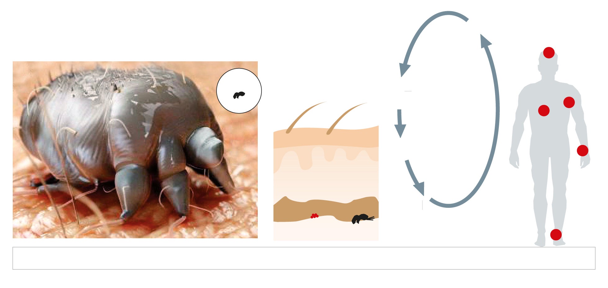 La sarna 'resucita' en La Rioja con más de 70 afectados en los tres ...